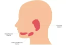 Submandibular Gland Cancer | Oralmed