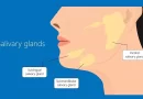 Submandibular Gland Cancer | Oralmed